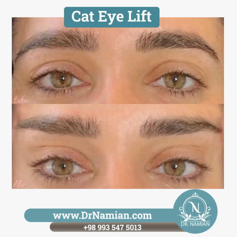 The Siren Gaze: Master the Cat Eye Lift Botox in Shiraz